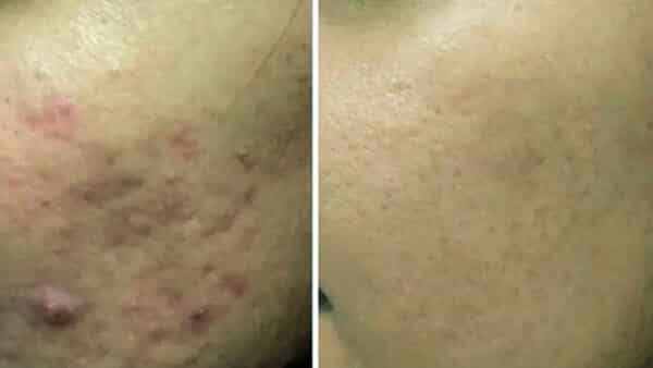Scar Reduction Overcoming Scars with Laser Treatment