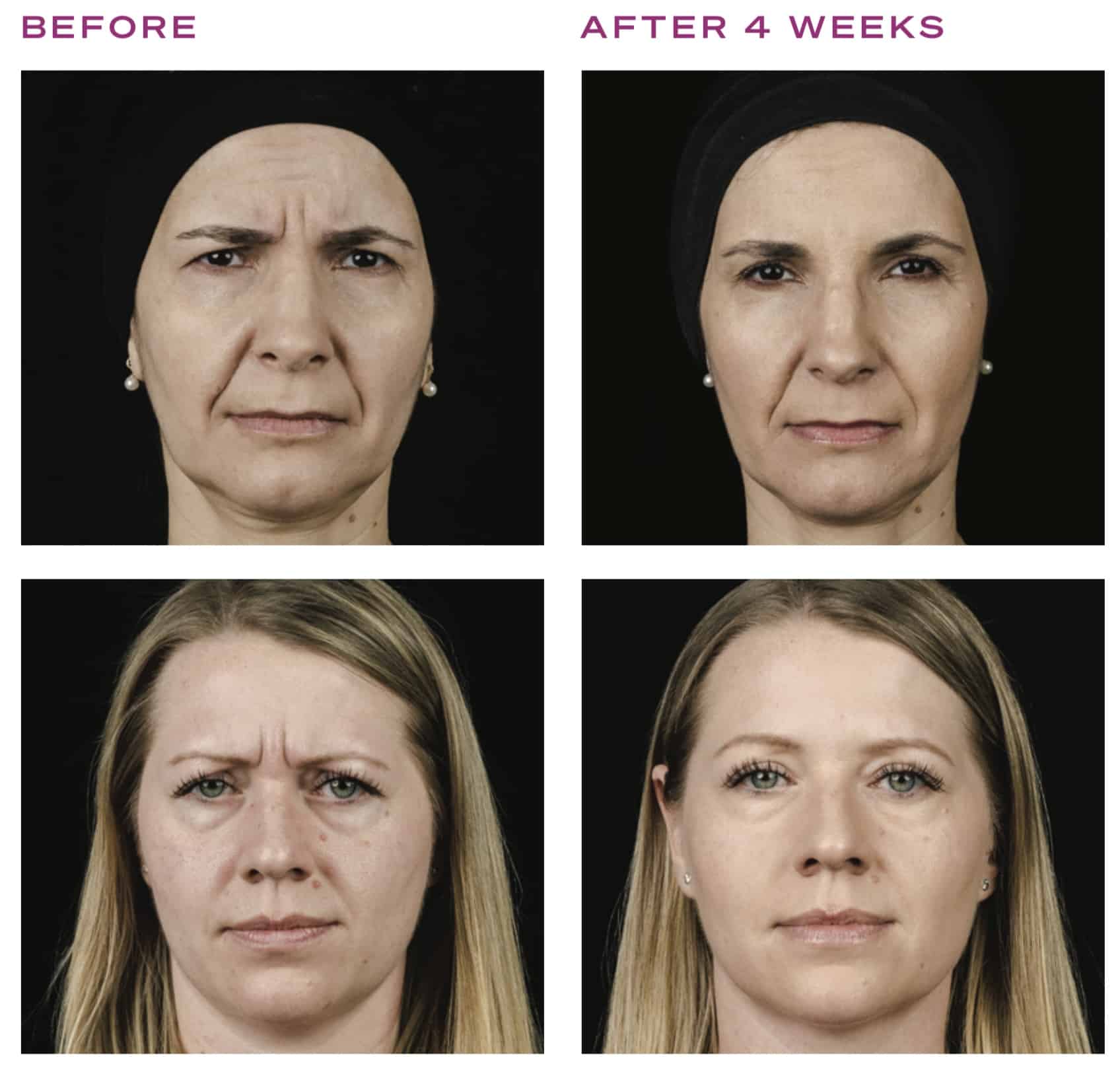 Say Goodbye to Wrinkles: Exploring the Benefits of Line Relaxer